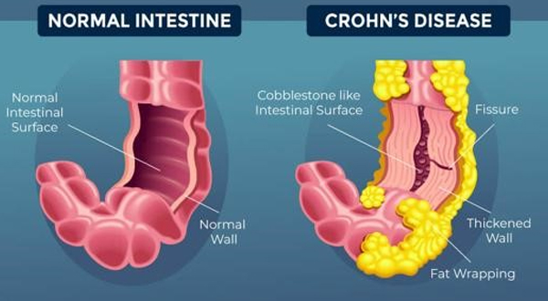 Crohn s Disease